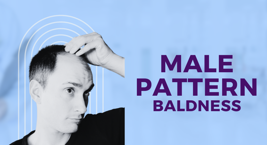 Best Male Pattern baldness clinic in Narayanguda, Hyderabad